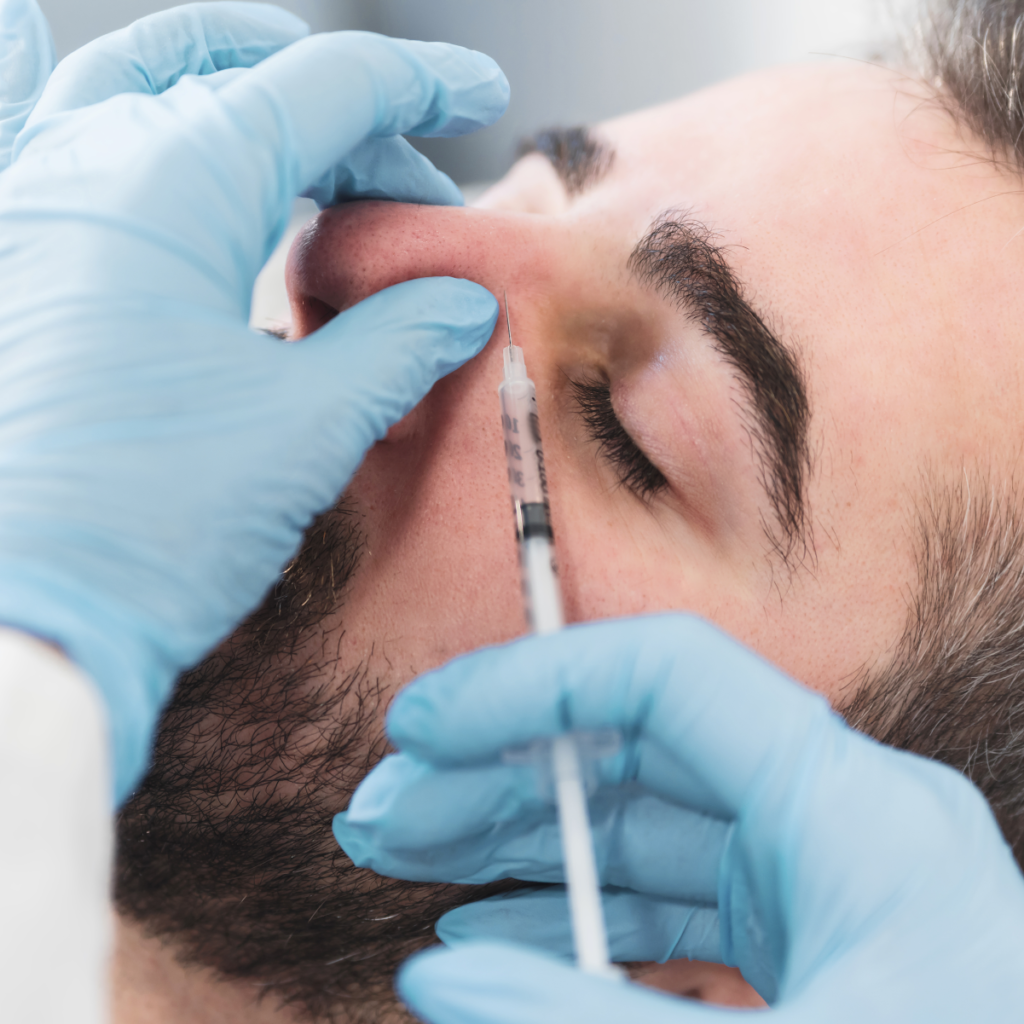 Non-surgical nose correction with HA dermal filler in Chiswick