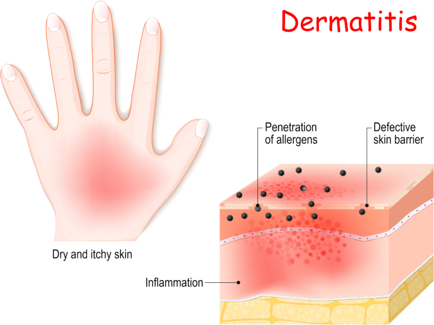 Understanding Eczema: Causes, Symptoms, and Treatments - Parkland ...