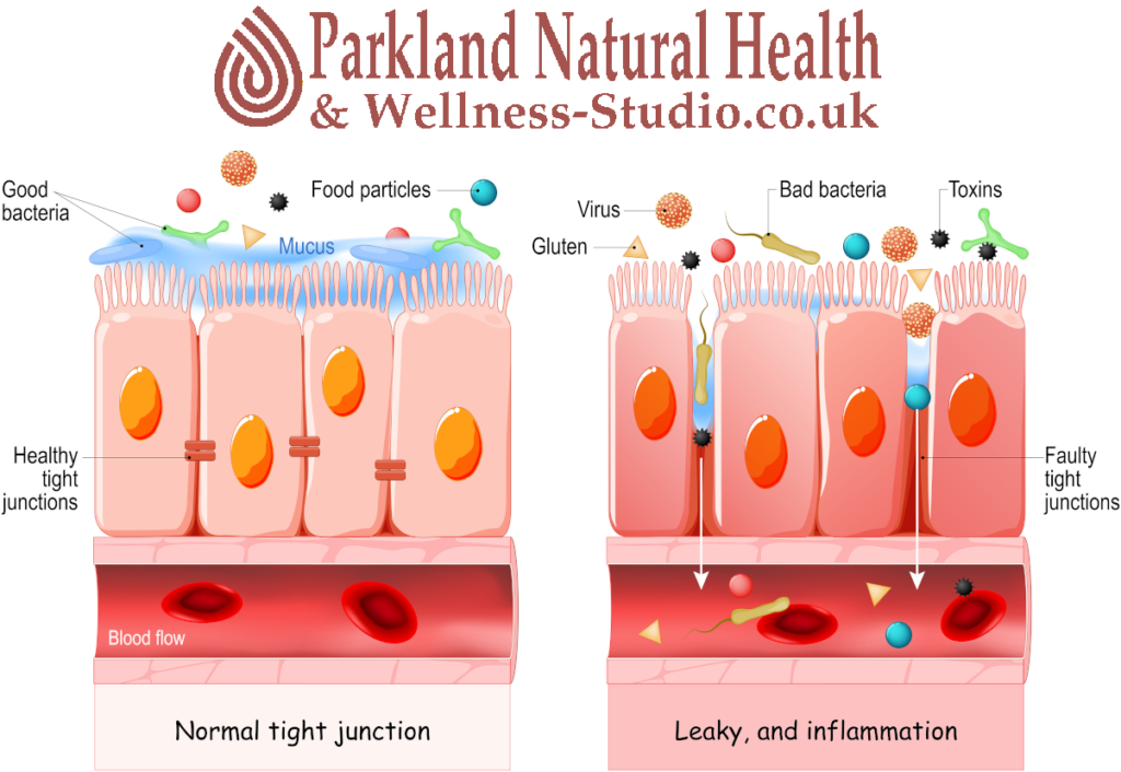 Leaky Gut Syndrome explained at Parkland Natural Health, London